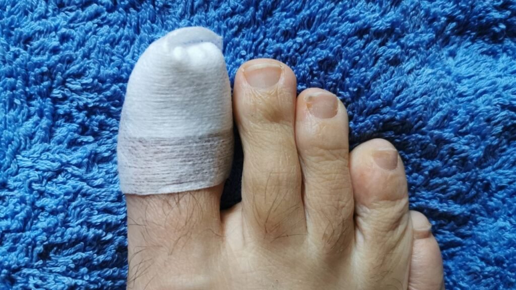 What is black toe nail fungus? - The Toe Nail Clinic