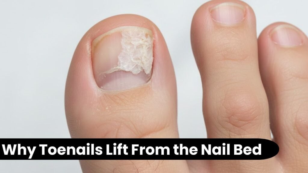 Subungual Hematoma vs Fungus: How to Tell the Difference in 30 Seconds ...